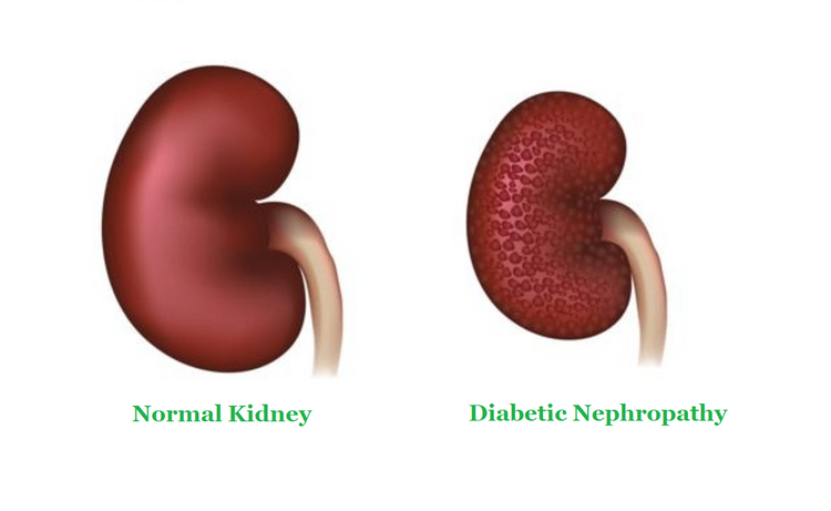 Diabetic Nephropathy Causes, Symptoms, Treatment and Prevention – Lets ...